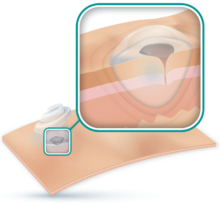 Hydrogel Dressing - Wound Care Range - ActivHeal Hydrogel