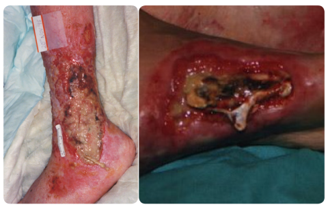 Wound Infection - The Stages of Infection - ActivHeal - Education